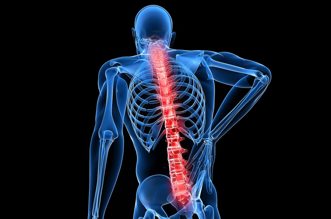 Osteocondrosis de la columna lumbar: síntomas, causas, grados ...